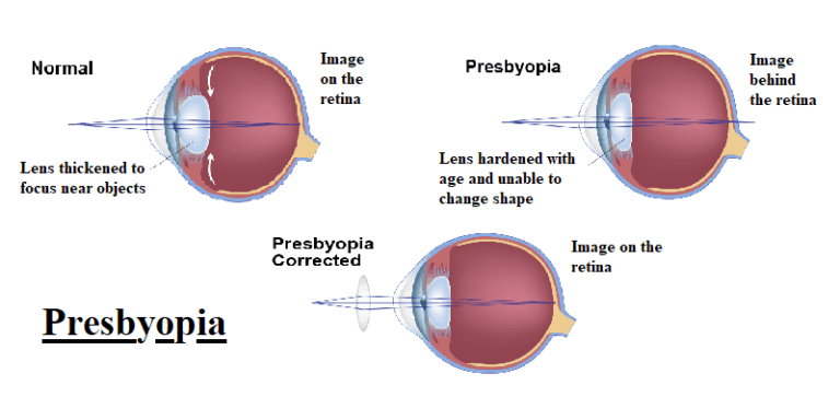 Penyakit Mata Tua Pada Lansia: Presbiopi • Deherba.com