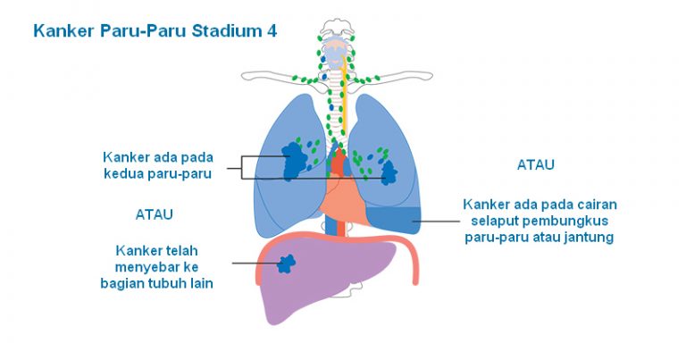 Kanker Paru-Paru: Info Lengkap bagi Anda yang Peduli Keshatan