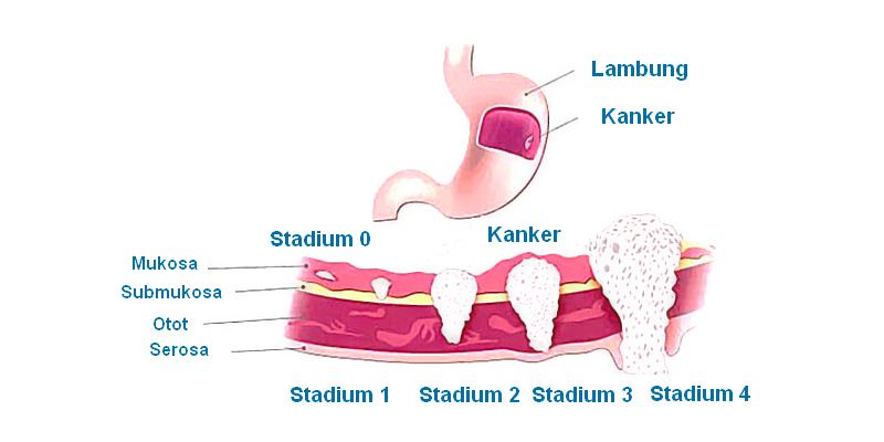 Stadium Kanker Lambung: Info Penting bagi Para Penderita Kanker