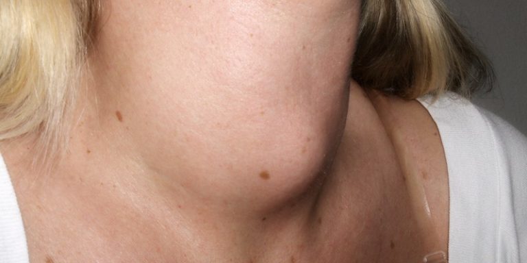 Tumor Tiroid: Info Penting bagi Anda yang Peduli Kesehatan • Deherba.com