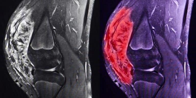 Kanker Sarkoma, Kanker yang Bisa Muncul Dimanapun • Deherba.com