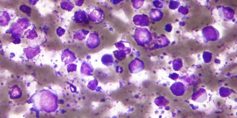 Kanker Limfoma: Kanker pada Sistem Getah Bening • Deherba.com