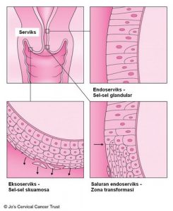 Letak Kanker Serviks Ada Dimana? • Deherba.com