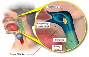 Penyakit Kanker Nasofaring: Penyebab dan Gejalanya • Deherba.com