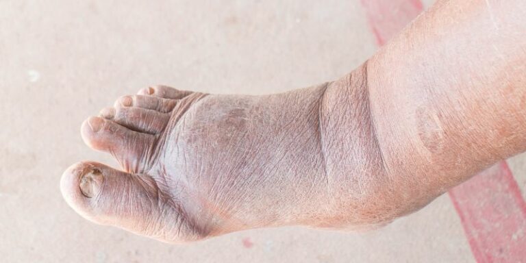 Penyakit Diabetes Nefropati: Definisi, Gejala, dan Pengobatannya