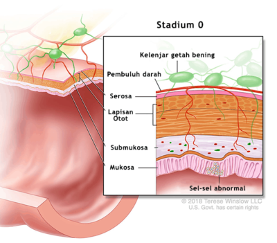 Stadium Kanker Usus • Deherba.com