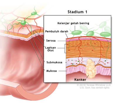 Stadium Kanker Usus • Deherba.com