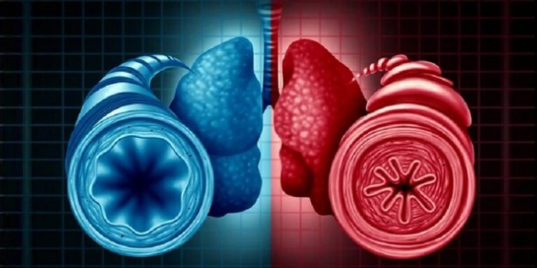 Solusi Obat Asma Di Apotik Terbaik Untuk Tuntaskan Asma • Deherba.com