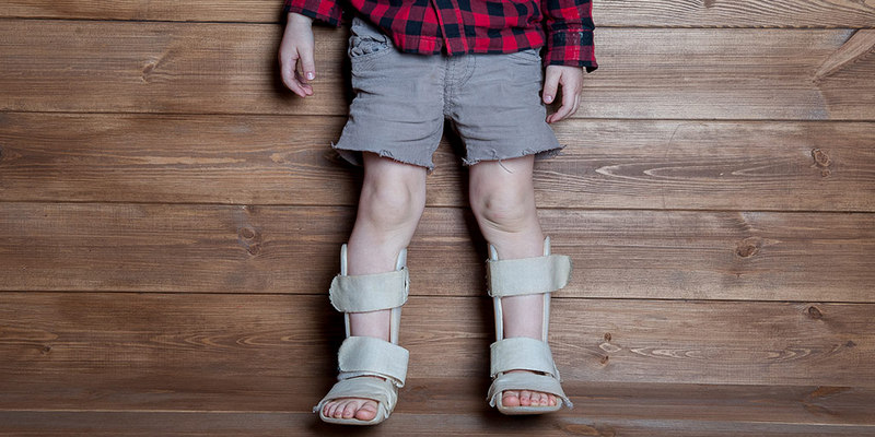 Penyakit Rakitis: Penyebab, Ciri-Ciri, Cara Mencegah & Mengatasinya ...