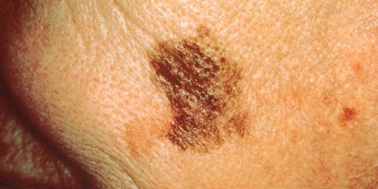 Kenali Perbedaan Tahi Lalat dan Kanker Kulit dengan Aturan ABCDE ...